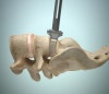 Ns수술 Alifanterior Lumbar Interbody Fusion 전방 요추 추체간 유합술 네이버 블로그